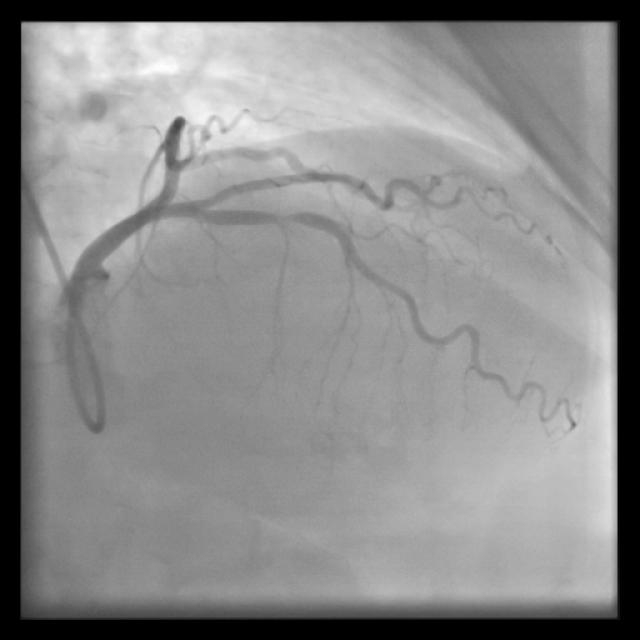 cad-stenosis Instance Segmentation Dataset by farhat abbas university