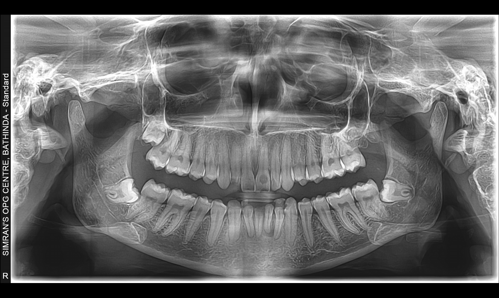 Top Tooth Datasets and Models | Roboflow Universe