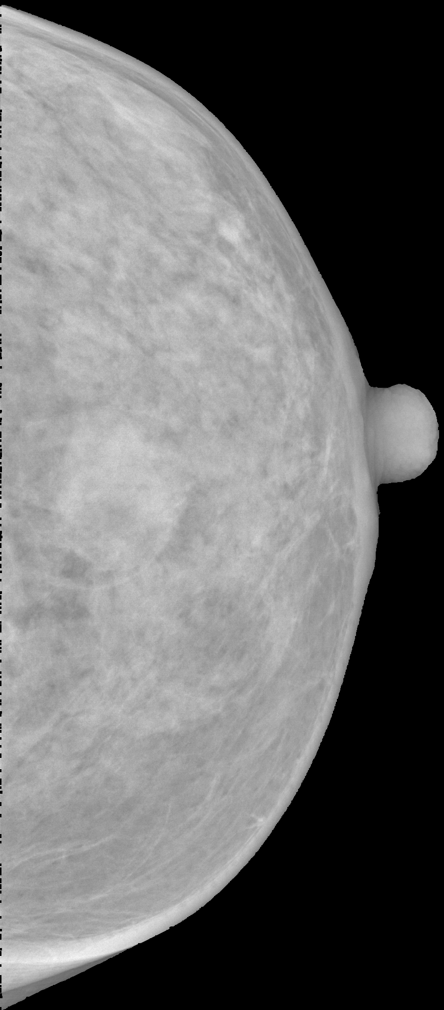 Mammography Detection Object Detection Dataset By Mammography
