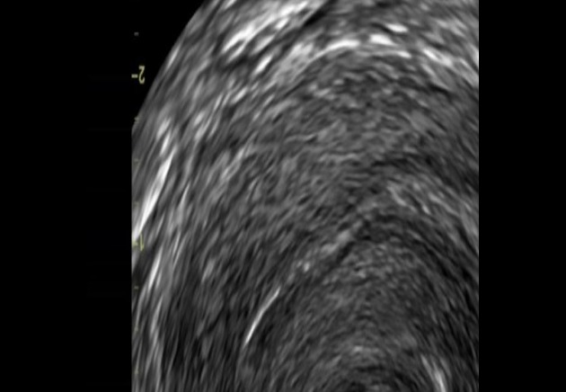 PCOS Ultrasound Object Detection Dataset by KM