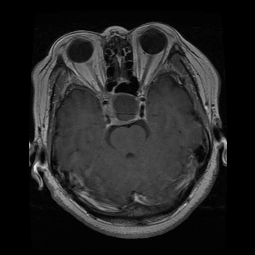 Brain Tumour Classification Object Detection Dataset By Projectpearpn