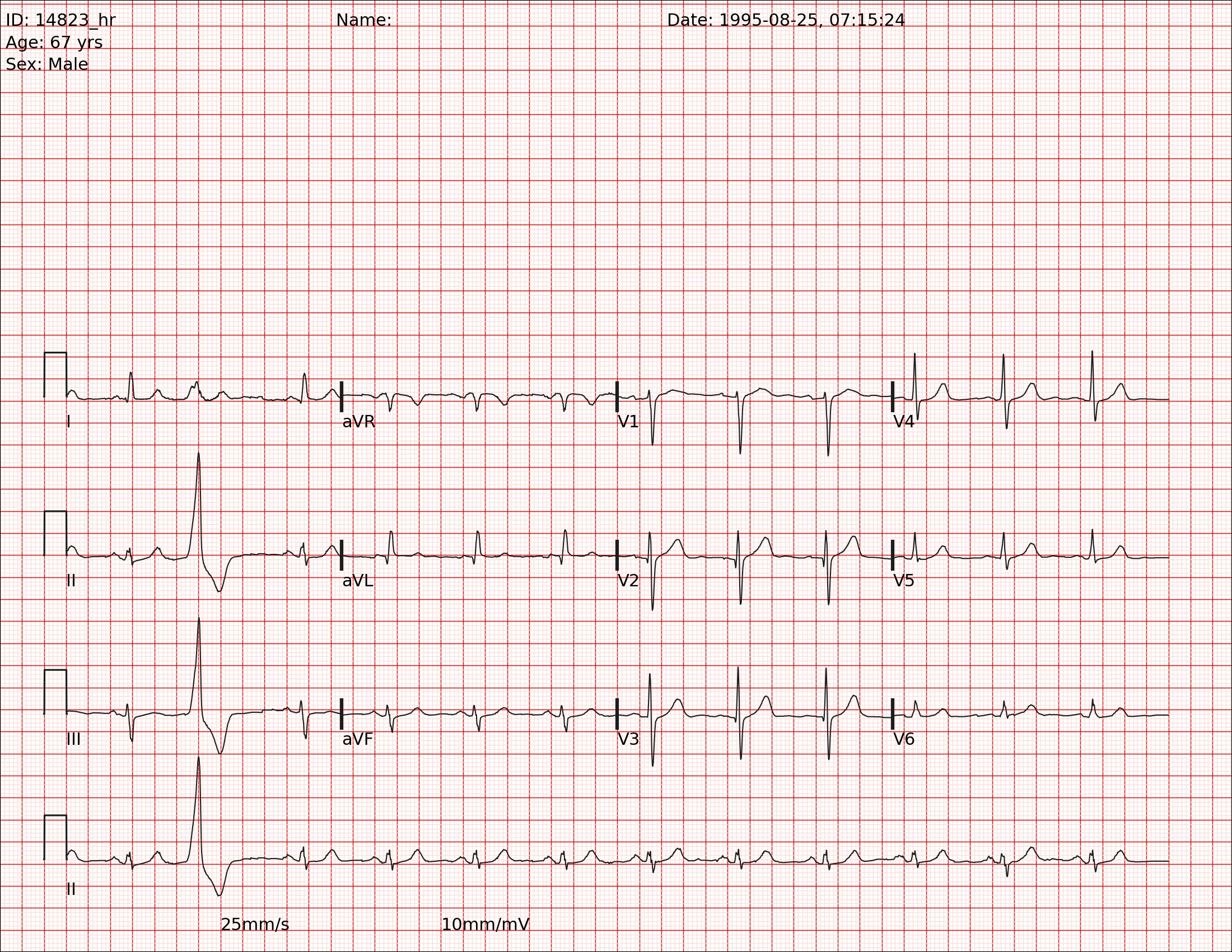 ECG labeling - detection Object Detection Dataset by ecg