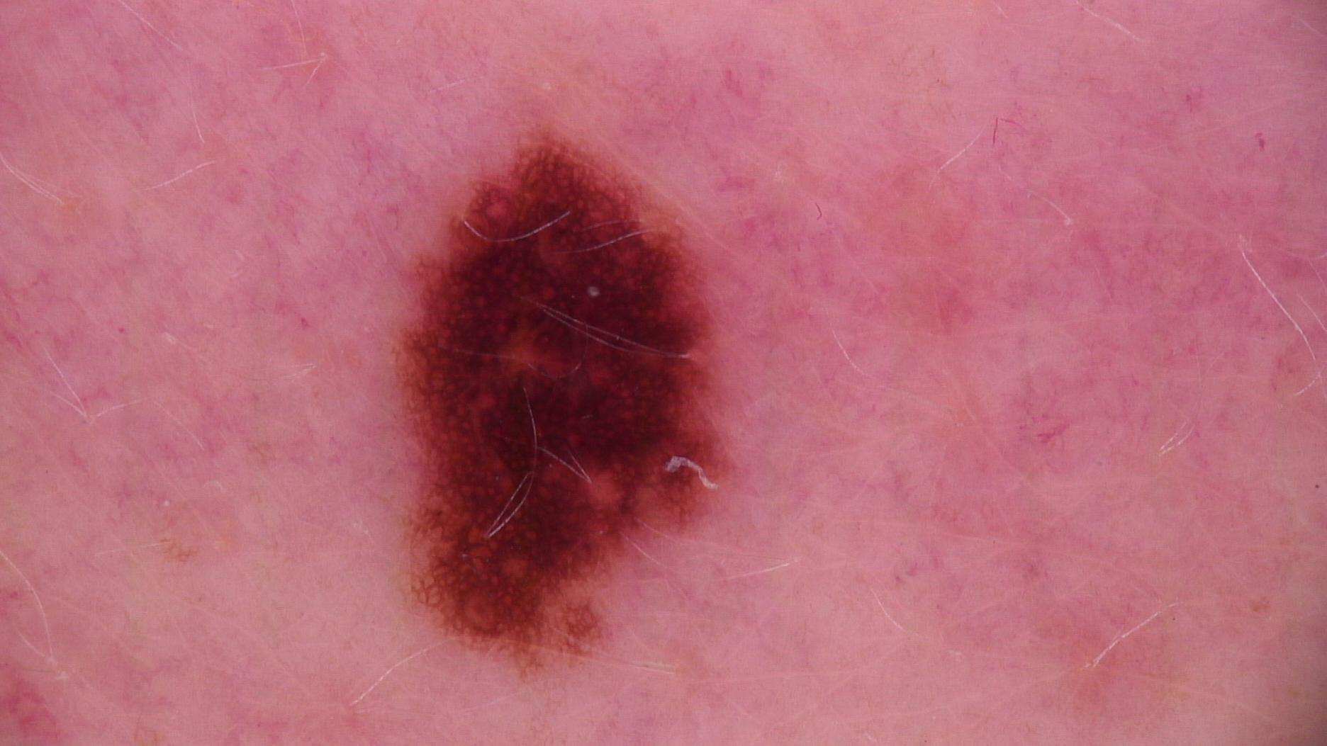 Melanoma Detection2022 Object Detection Dataset By Melanoma