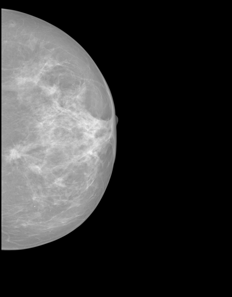 Breast Detection Object Detection Dataset And Pre Trained Model By Breast