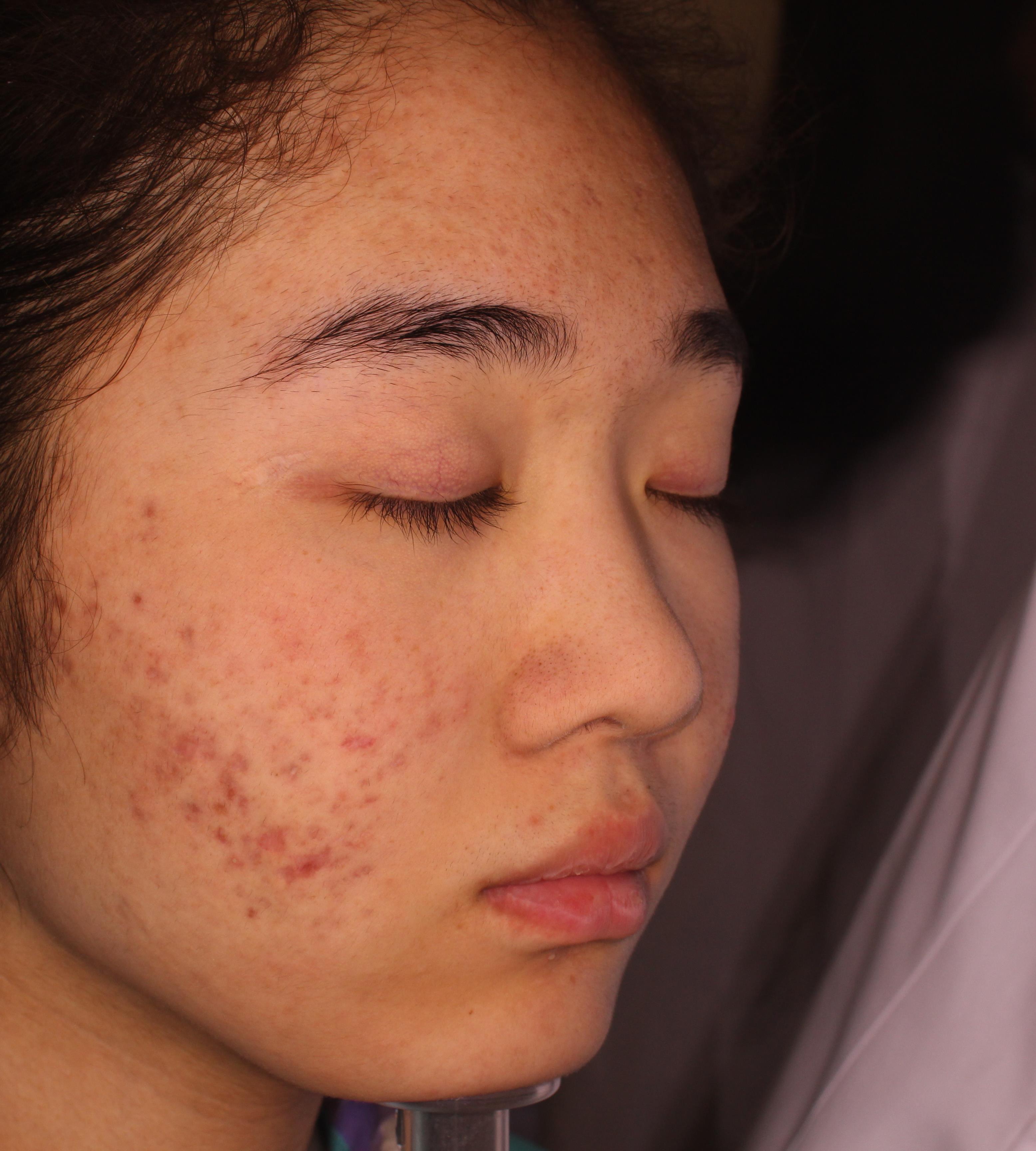 skin issue Instance Segmentation Dataset by redness