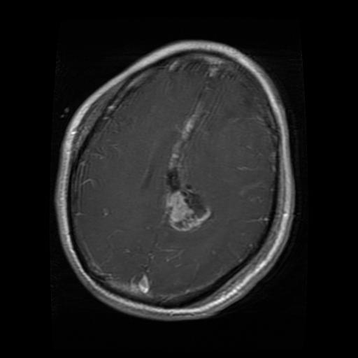 Mri For Brain Tumor Object Detection Dataset By Mydataset