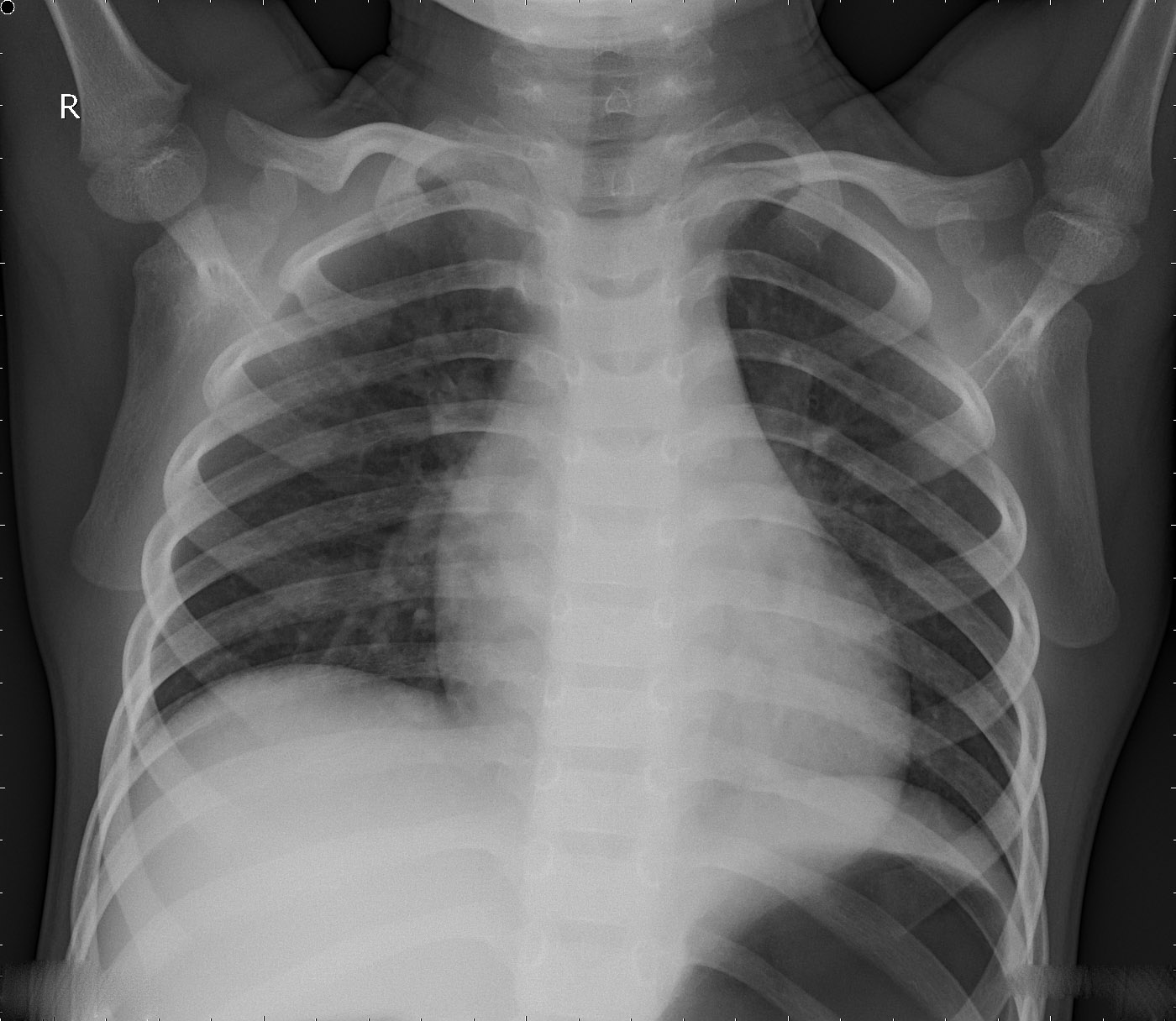 pneumonia-classification Classification Dataset by Inatel