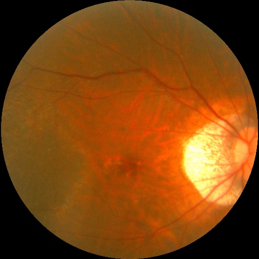 eye-disease Classification Model by Nikita Moglan