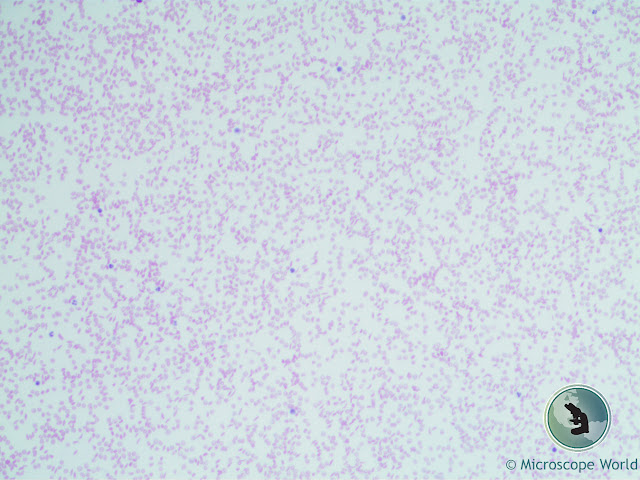 sickle cell anemia detection v.5 Object Detection Dataset by new ... sickle cell anemia detection v.5 Object Detection Dataset by new ...
