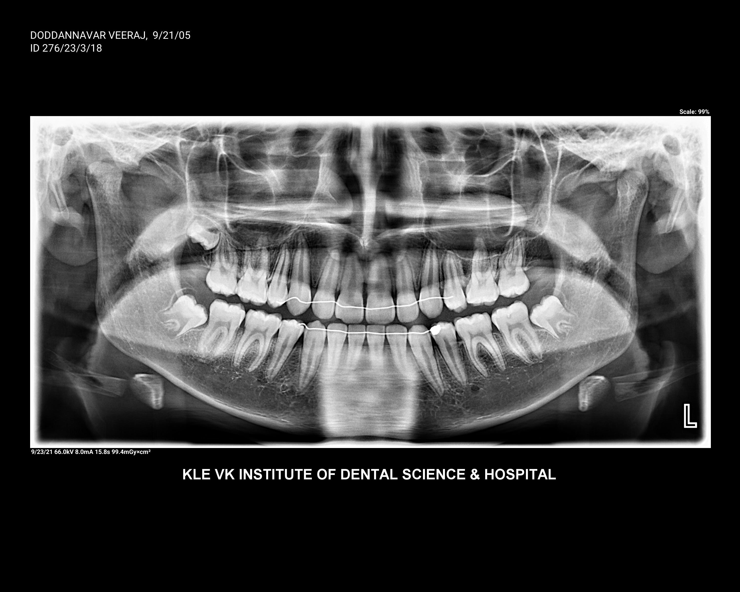 Tooth Segmentationa Instance Segmentation Dataset V1 2023 08 16 10 26am By Teeth Segmentation