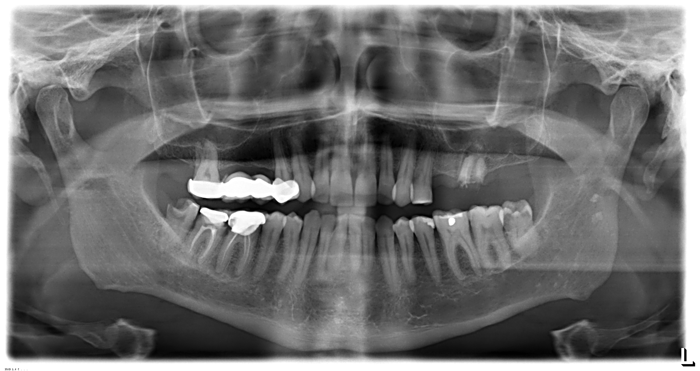 IntelliDent Instance Segmentation Dataset and Pre-Trained Model by FYP