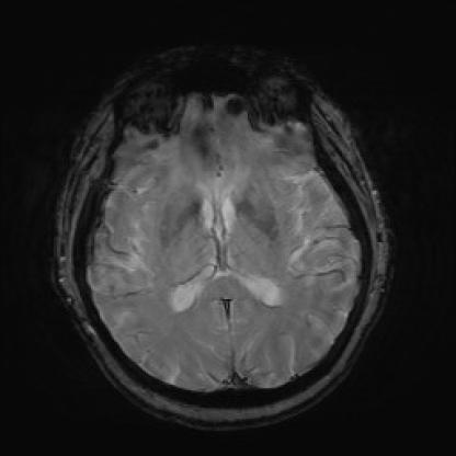 alzheimer's detection Object Detection Dataset and Pre-Trained Model by ...