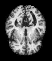 alzheimer-classification Classification Dataset by Evil