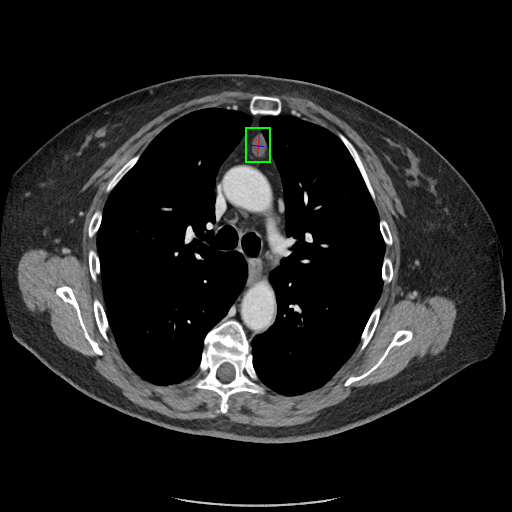 Lung Cancer Object Detection Dataset by YOLO