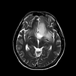 Brain Tumor Segmentation Instance Segmentation Dataset by Yuu