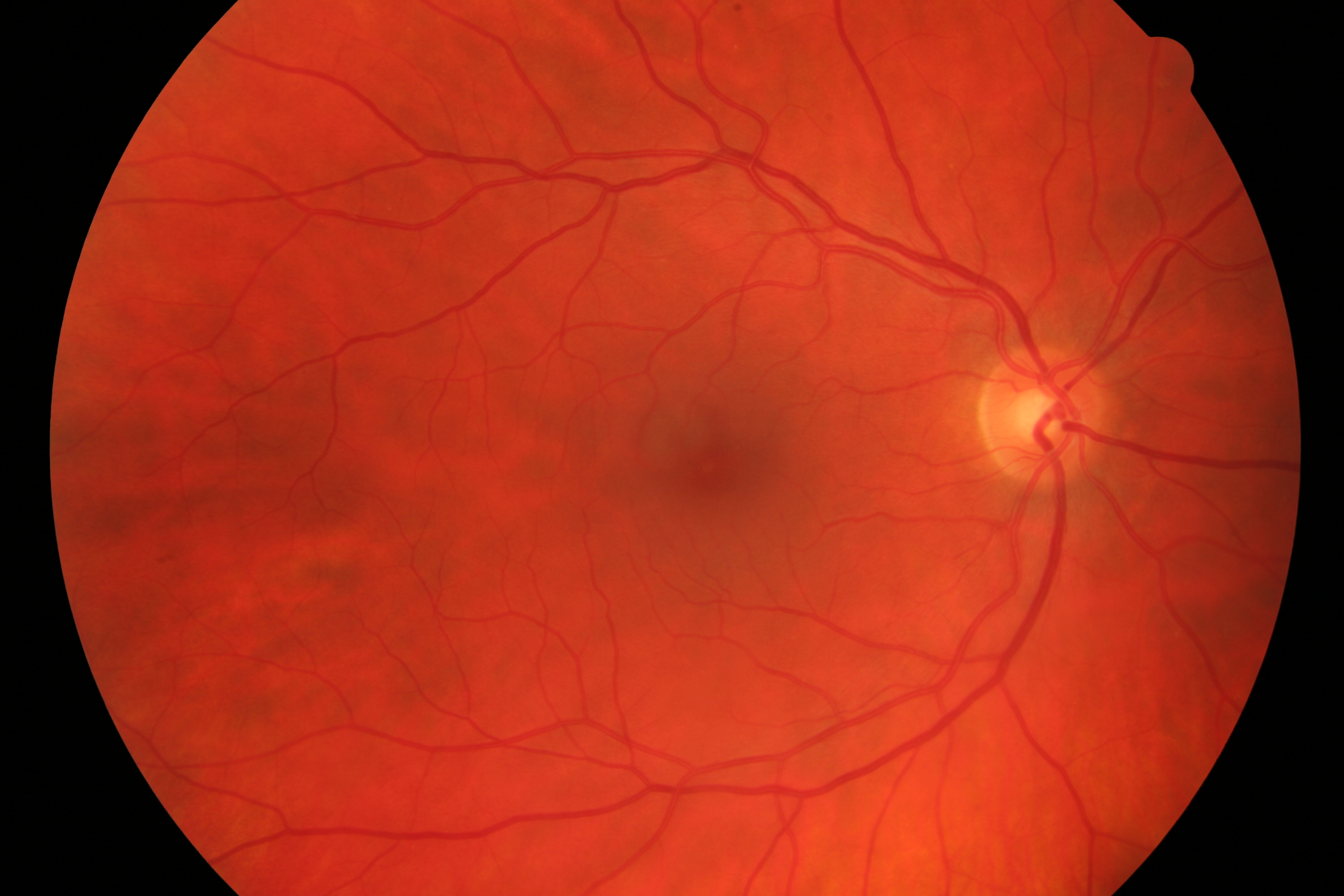 Glaucoma Object Detection Model By Glaucoma
