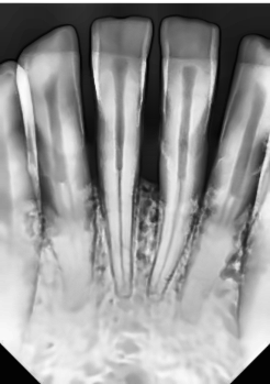 Dental Bone Loss Detection Instance Segmentation Model by Dental OPG ...