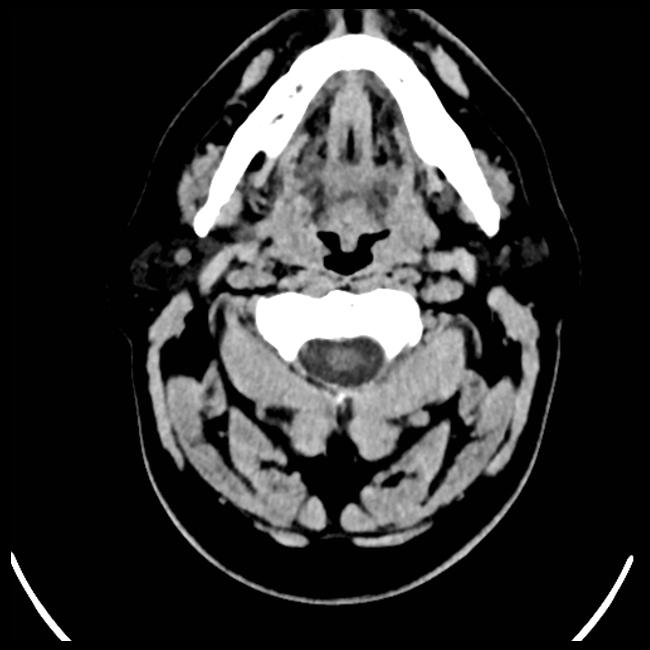 Brain Stroke Detection Object Detection Dataset And Pre Trained Model By Coimbatore Institute Of