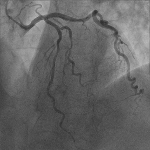 Stenosis Instance Segmentation Model by Tano