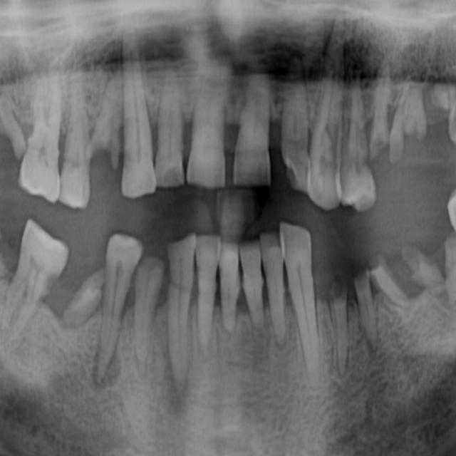 teeth problem detection - Roboflow Universe
