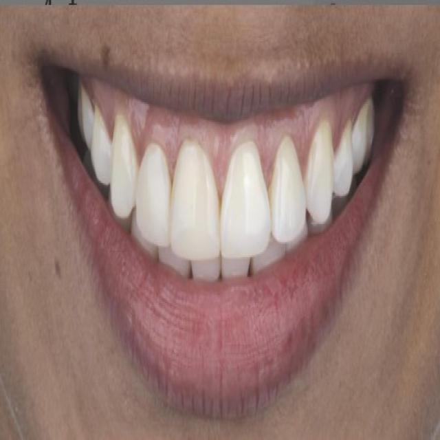 Teeth Object Detection Dataset By K
