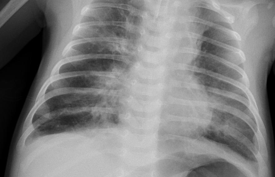 Detection Of Pulmonary Diseases Object Detection Model By Health