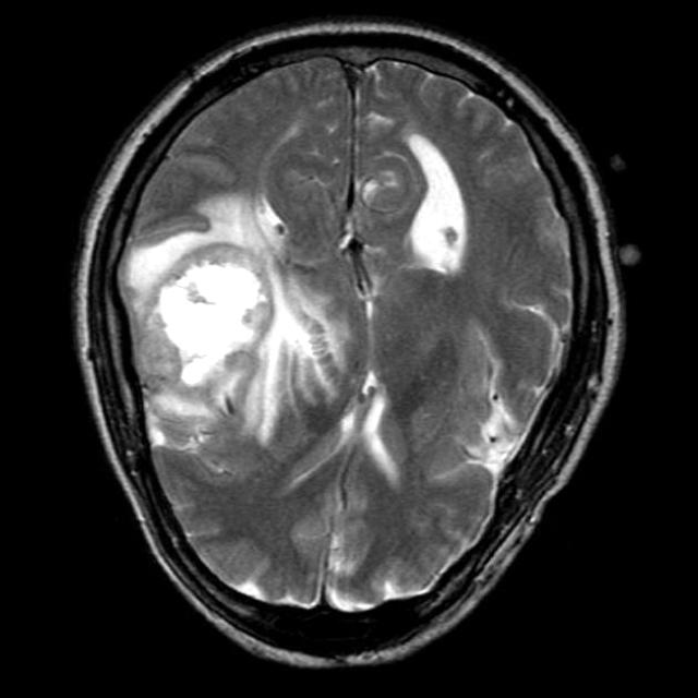 brain_tumor Object Detection Dataset by Udayana University