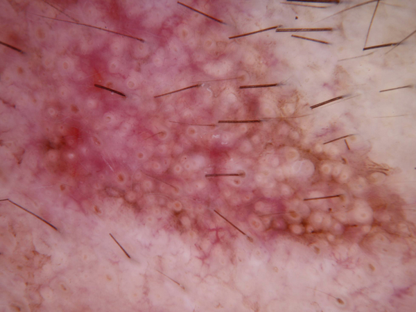 Dermatology Preliminary Project Object Detection Dataset By Types Of Skin Cancer