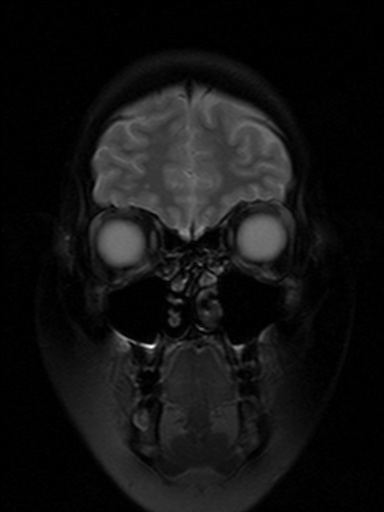 Coronal_Segmentation Object Detection Model by Coronal