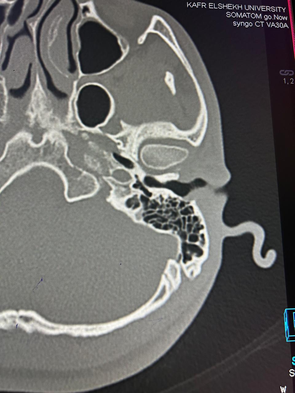 mastoid aeration detection Keypoint Detection Model by kafrelshiekh ...