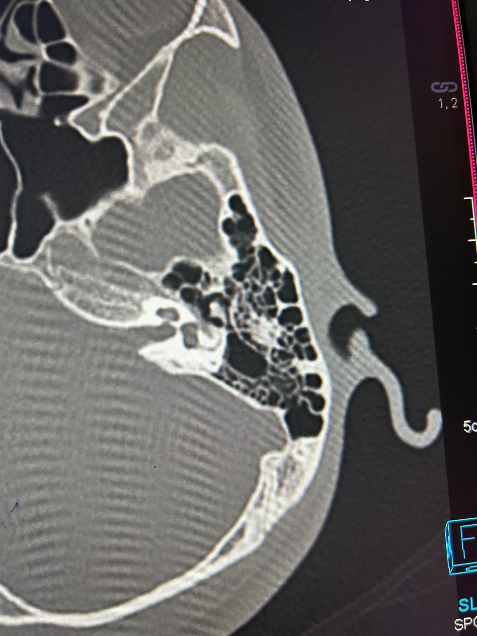 middle ear opacity detection mod Instance Segmentation Model by ...
