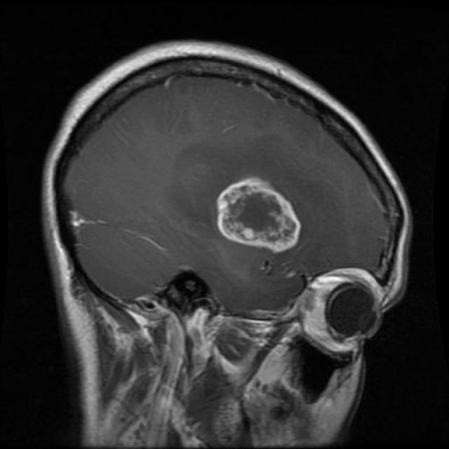 brain_tumor_combined_final Object Detection Dataset by jhayer