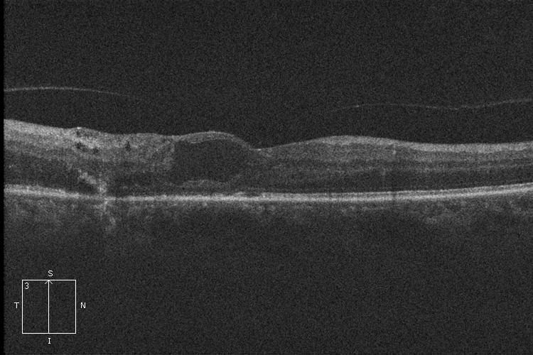 Retinal OCT Classification Model by Unitec