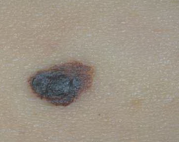 skin cancer Object Detection Dataset by CV