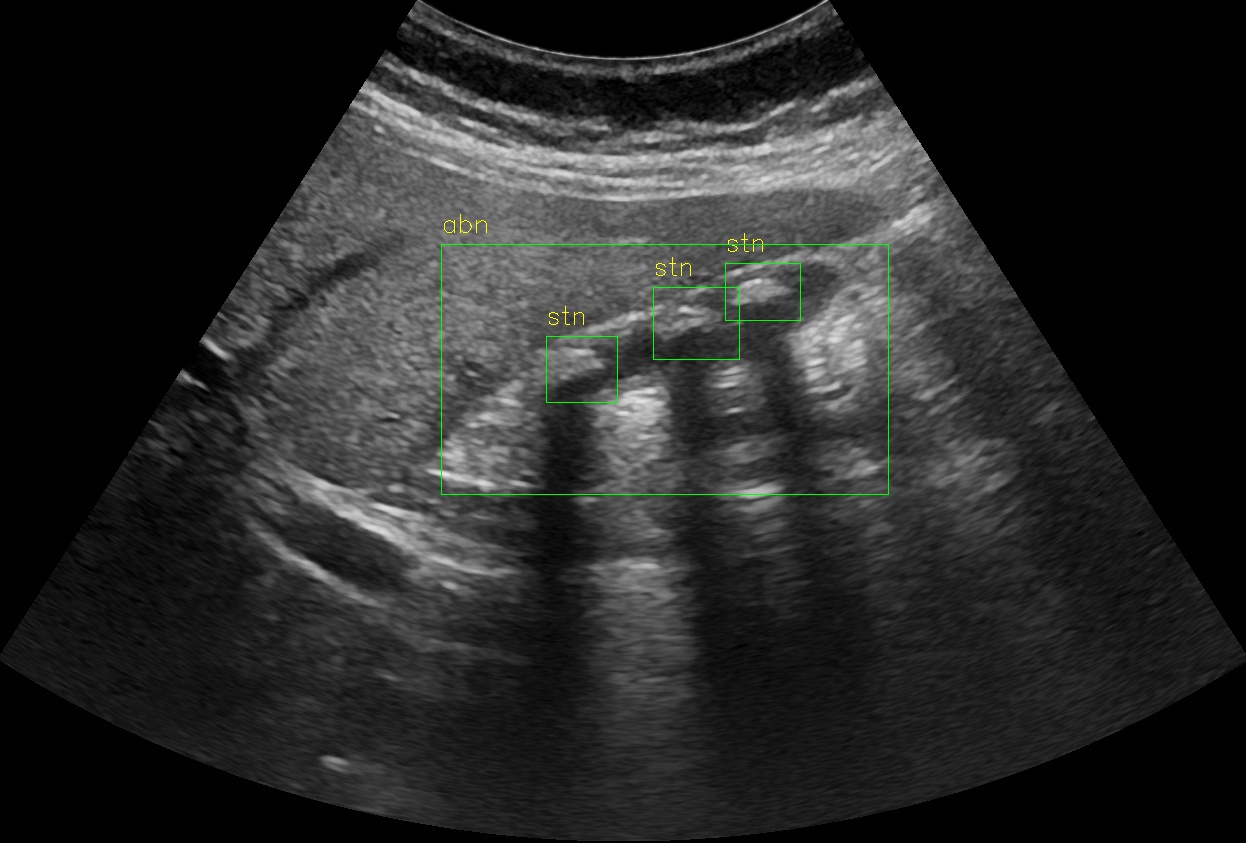 stone detection Object Detection Dataset by parul university