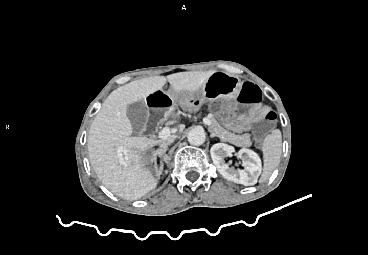 Segmentasi CT Scan - Roboflow Universe
