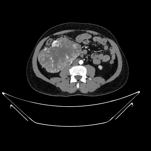 How to Use the Deteksi Tumor Ginjal Object Detection API
