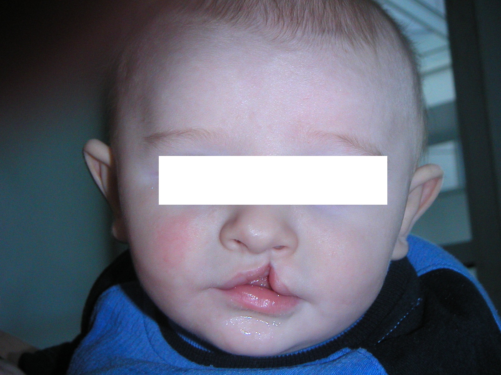 cleft lip detections Object Detection Model by hamza