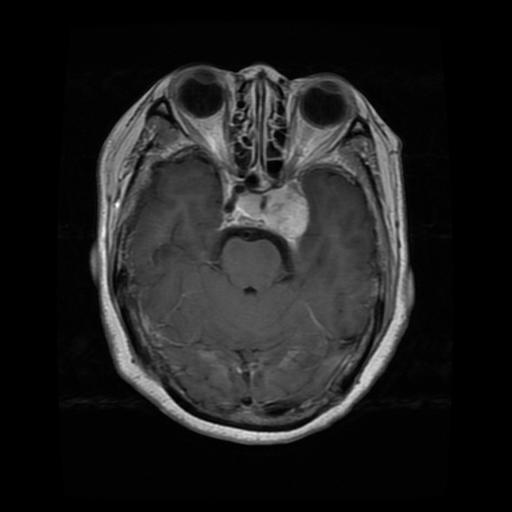 Tumor segmentation Instance Segmentation Dataset by School