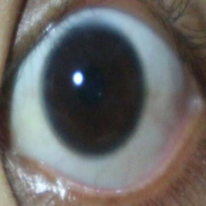 Cataract detection 2 Object Detection Model by SRM UniversityRamapuram