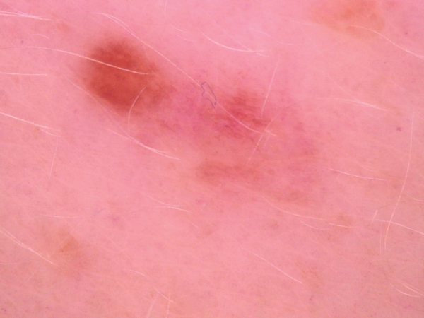 HAM10000_TEST Instance Segmentation Dataset by HAM10000TEST