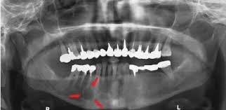 OPG_ANNOTATION_24 Object Detection Dataset (v10, 2025-02-26 6:36pm) by ...