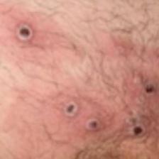 monkeypox Object Detection Dataset by klsukadha