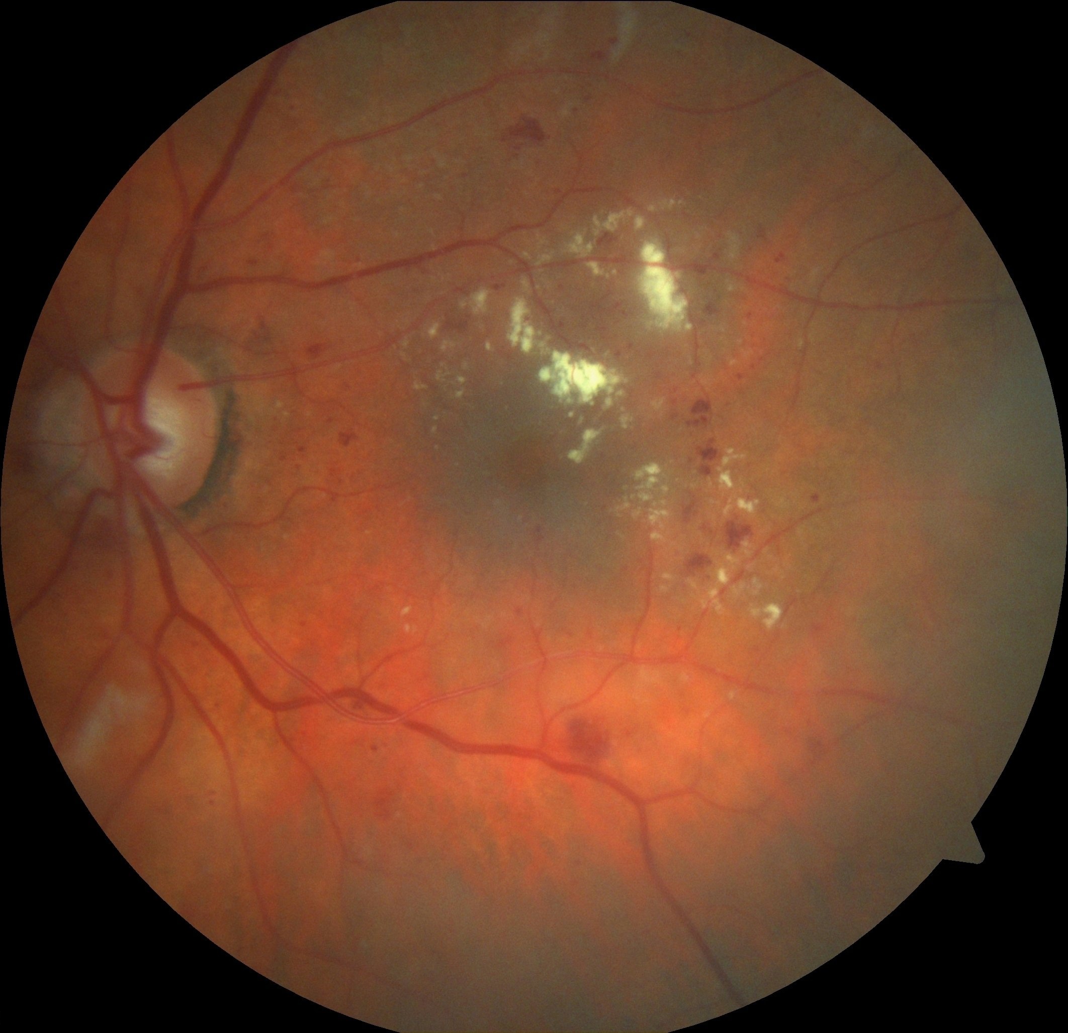 DIABETIC RETINOPATHY Classification Dataset by Harsha