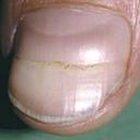 Beau Lines Detection Object Detection Dataset by MyWorkspace