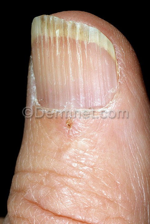 Aug Nail Classification Classification Dataset by MyWorkspace