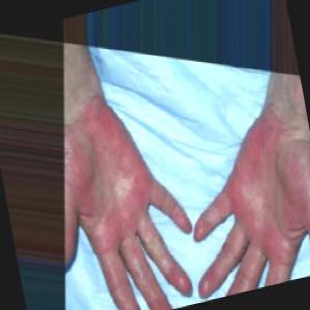 Burn victims Object Detection Model by ahmed essa