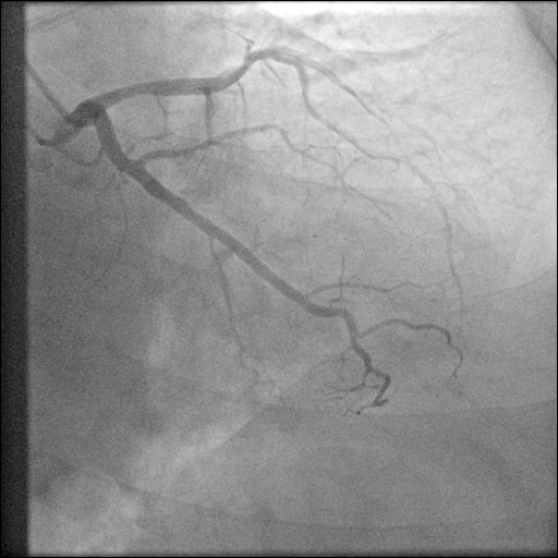 syntax_train Object Detection Dataset by Coronary Angiography
