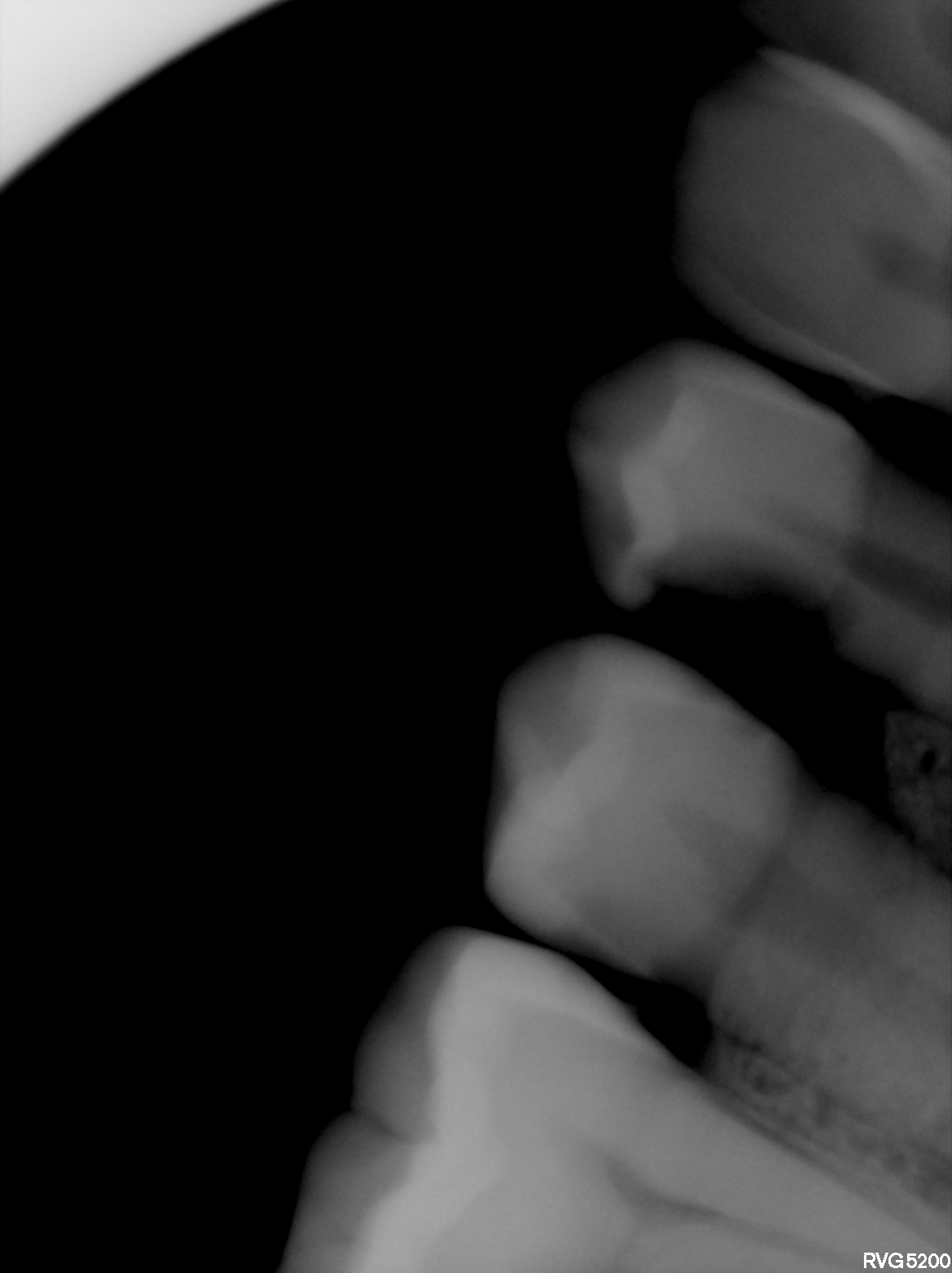 dental caries Instance Segmentation Model by jasmine
