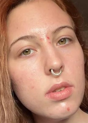 How to Use the acne detection Object Detection API